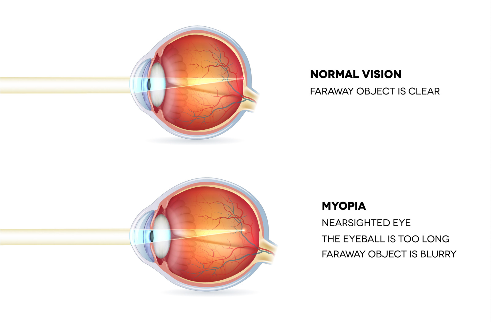 Myopia Control: Management & Treatment | Central Optometry