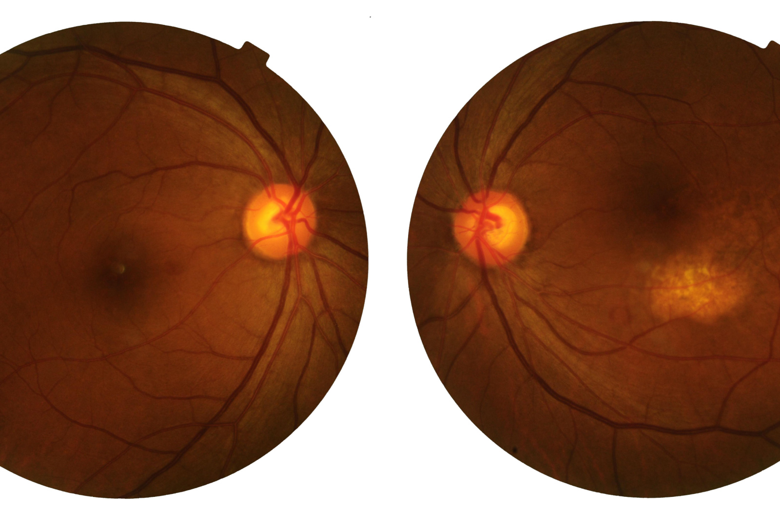 What Does Glaucoma Vision Look Like? | Central Optometry