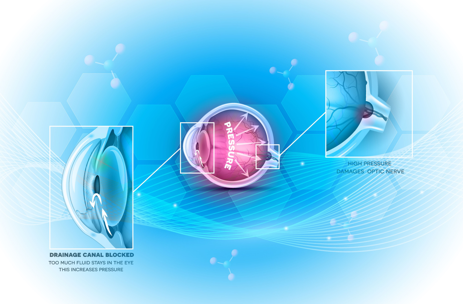 What Does Glaucoma Vision Look Like? | Central Optometry